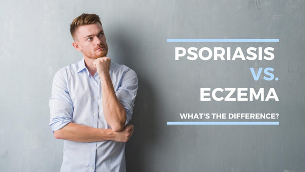 Psoriasis vs. Eczema: What’s the Difference? – Psoriasis Honey